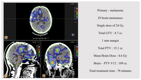 Cancers | Free Full-Text | Long-Term Results of Stereotactic Radiotherapy in Patients with at ...