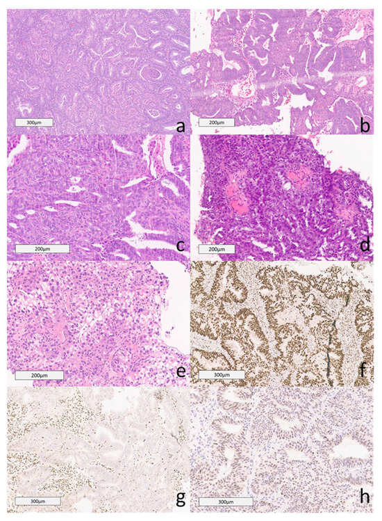 Endometrial Cancer: 2023 Revised FIGO Staging System and the Role of ...