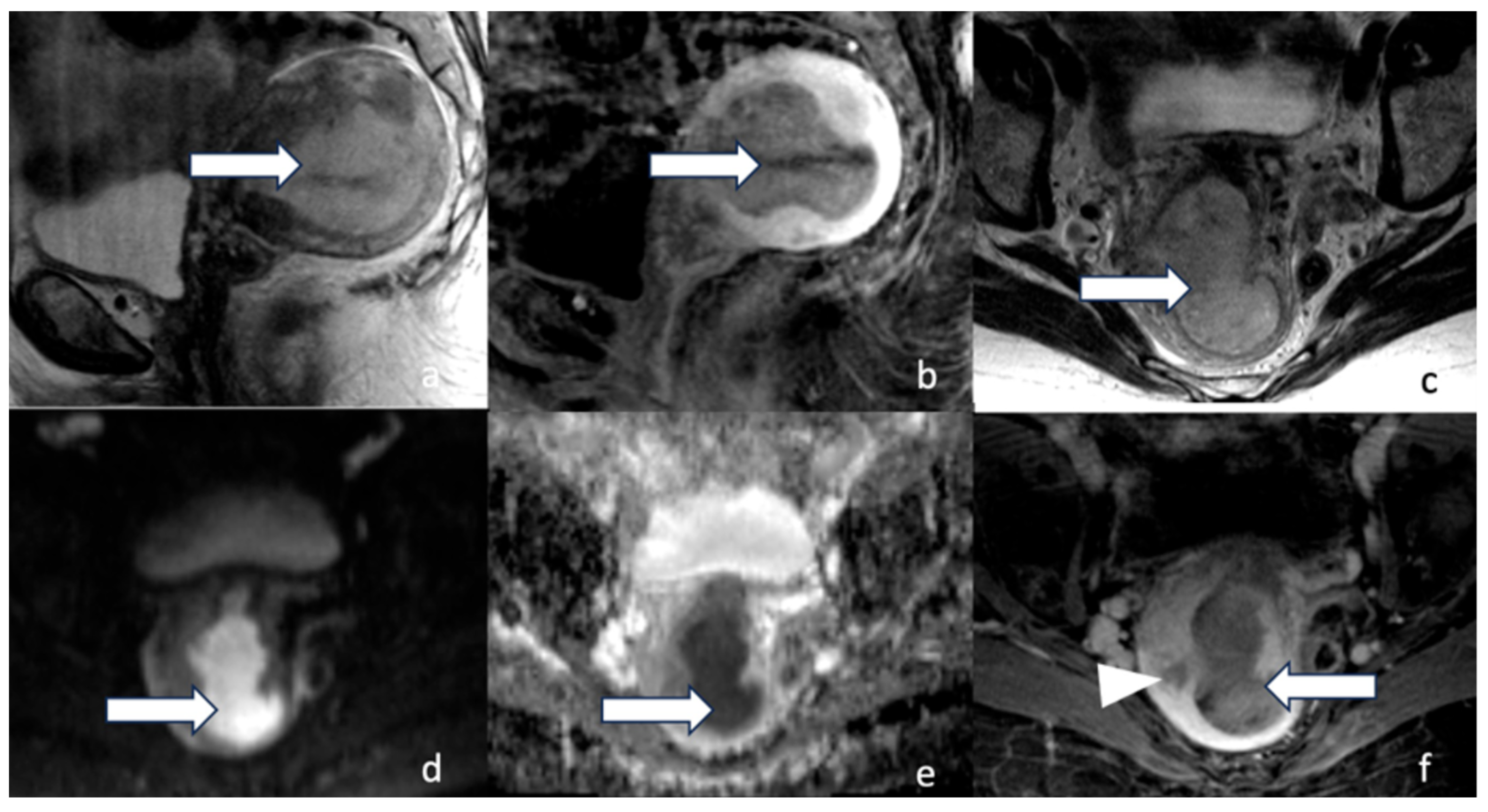 Endometrial Cancer: 2023 Revised FIGO Staging System and the Role of Imaging