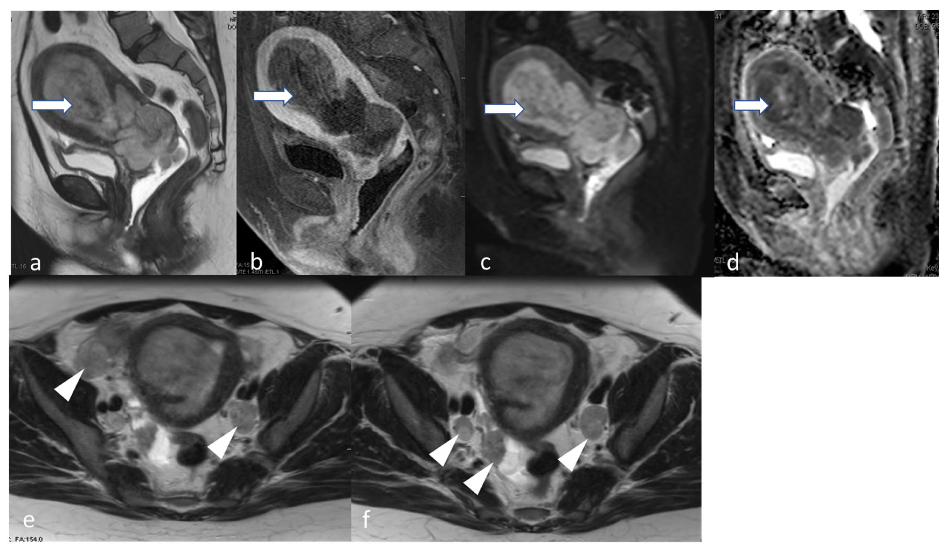 Endometrial Cancer: 2023 Revised FIGO Staging System and the Role of Imaging
