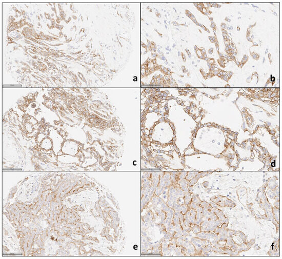 Heterogeneous Profile of ROR1 Protein Expression across Tumor Types