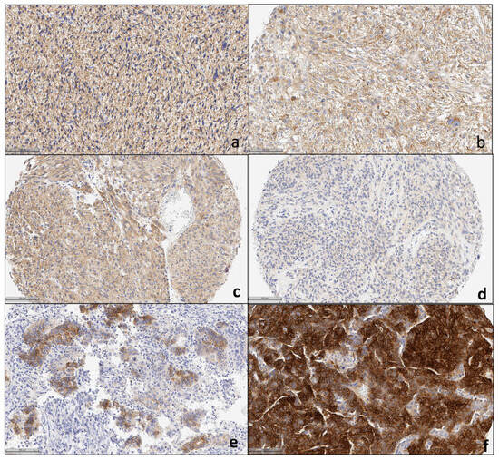 Heterogeneous Profile of ROR1 Protein Expression across Tumor Types