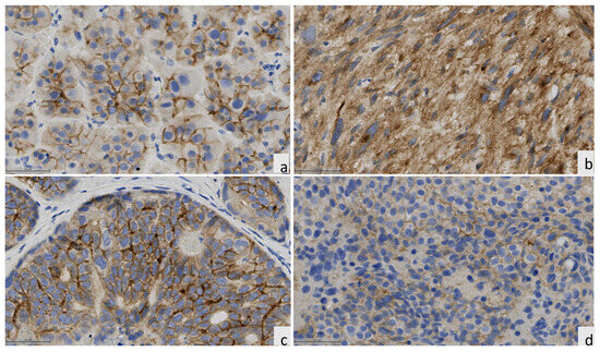 Heterogeneous Profile of ROR1 Protein Expression across Tumor Types