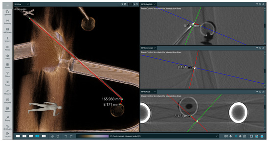 Mixed Reality Biopsy Navigation System Utilizing Markerless Needle ...