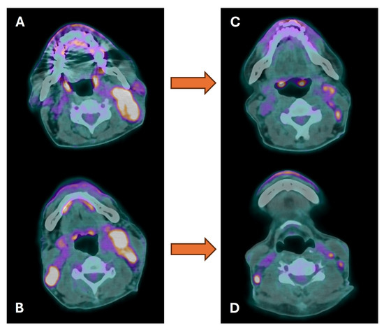 Role of 18F-FDG PET/CT in Head and Neck Squamous Cell Carcinoma: Current Evidence and Innovative ...