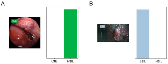 Deep Learning and High-Resolution Anoscopy: Development of an Interoperable Algorithm for the ...