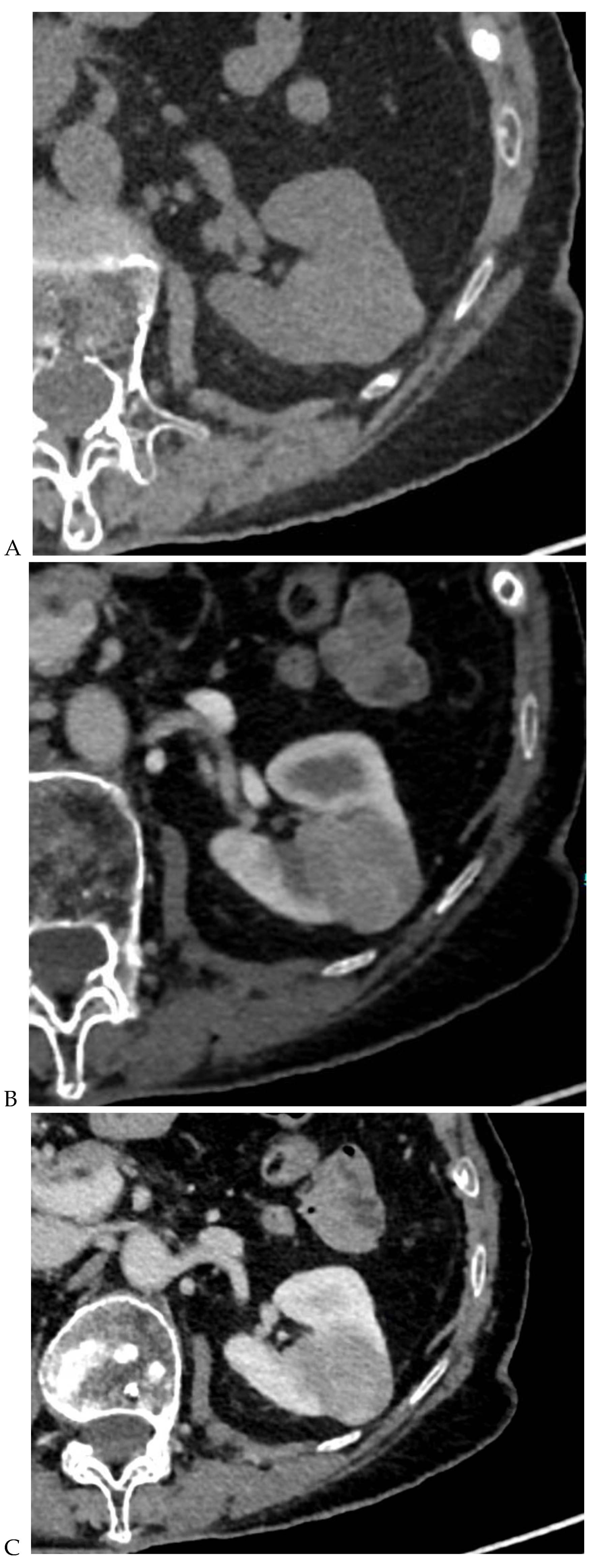 Update on Renal Cell Carcinoma Diagnosis with Novel Imaging Approaches