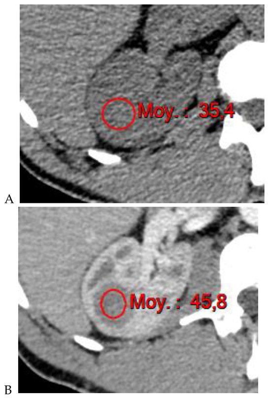 Update on Renal Cell Carcinoma Diagnosis with Novel Imaging Approaches