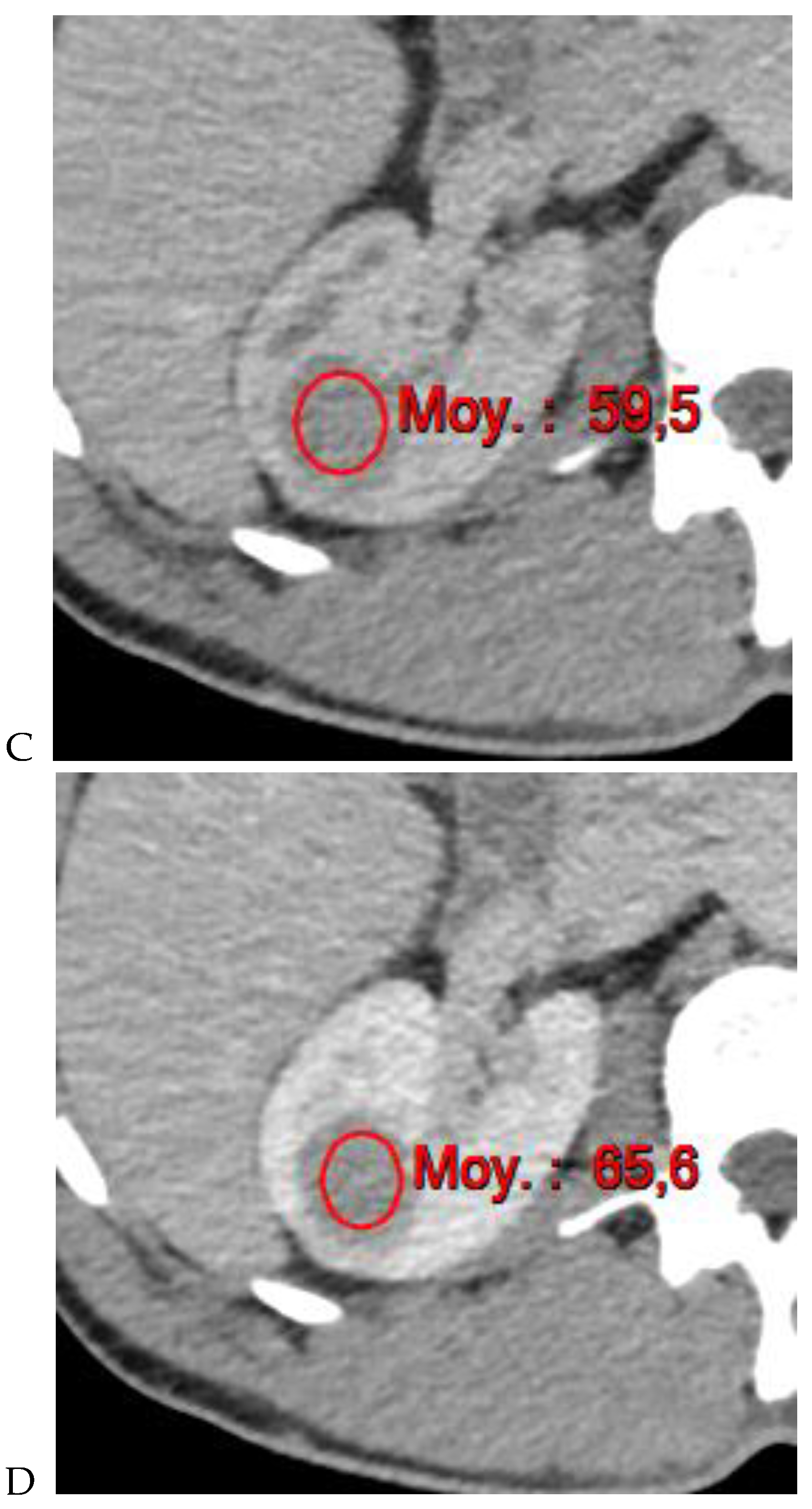 Update on Renal Cell Carcinoma Diagnosis with Novel Imaging Approaches