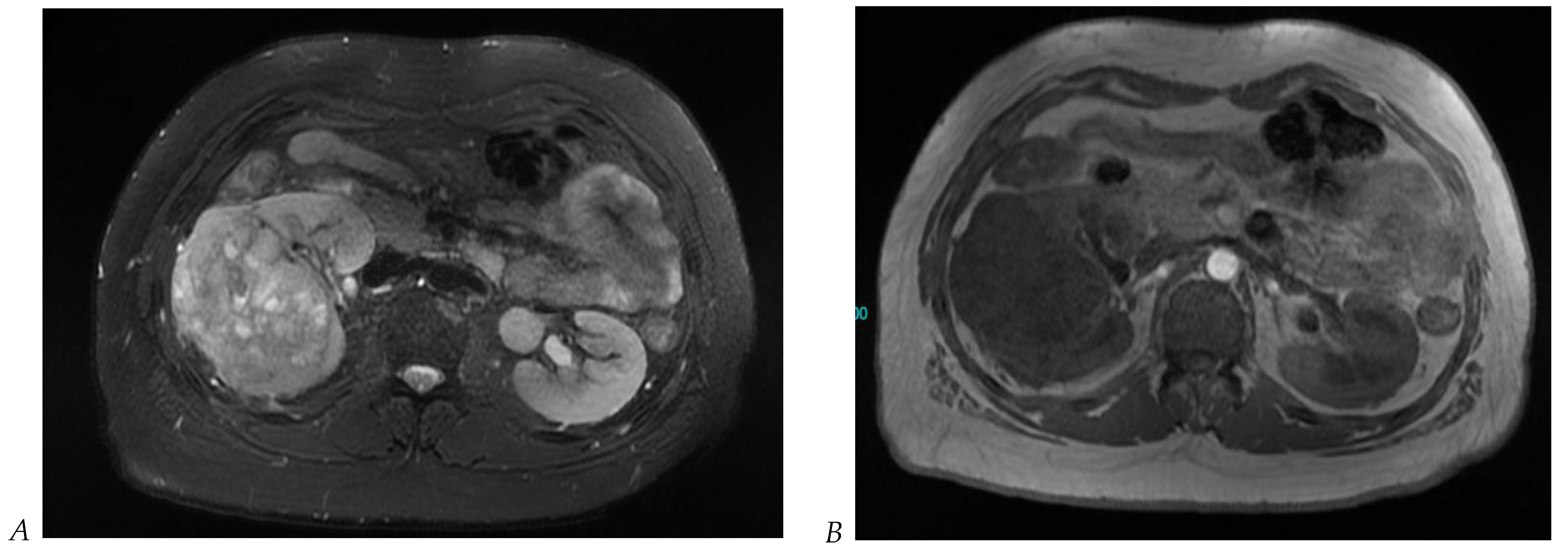 Update on Renal Cell Carcinoma Diagnosis with Novel Imaging Approaches