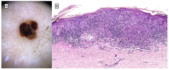 Skin Malignancies Due to Anti-Cancer Therapies