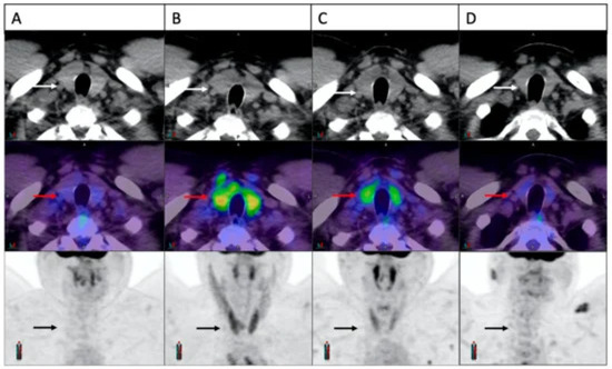 Is 18F-FDG-PET/CT an Optimal Imaging Modality for Detecting Immune ...