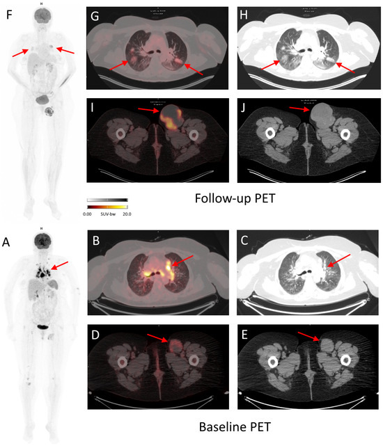 Is 18F-FDG-PET/CT an Optimal Imaging Modality for Detecting Immune ...