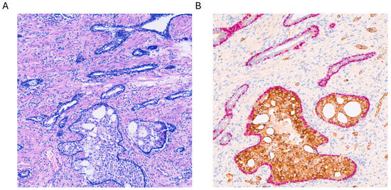 Cribriform versus Intraductal: How to Determine the Difference
