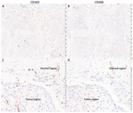 Prognostic Significance of CD163+ and/or CD206+ Tumor-Associated ...