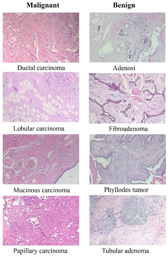 Ensemble Deep Learning-Based Image Classification for Breast Cancer Subtype and Invasiveness ...