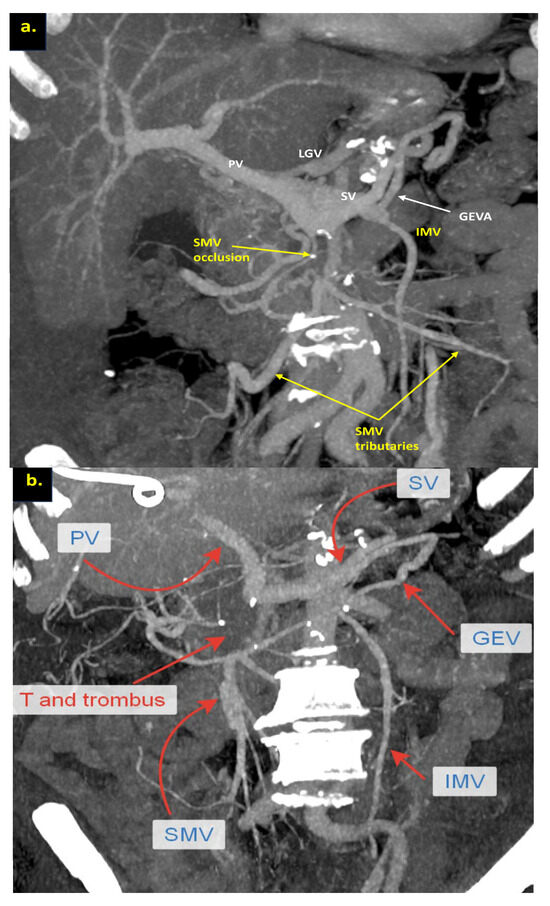 Pancreatectomy with En Bloc Superior Mesenteric Vein and All Its ...