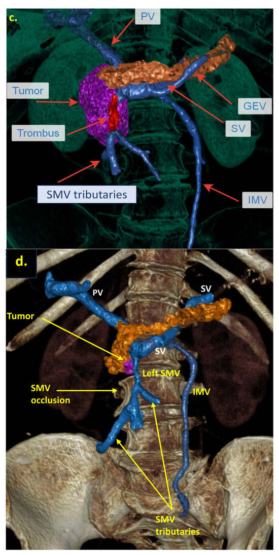 Pancreatectomy with En Bloc Superior Mesenteric Vein and All Its ...