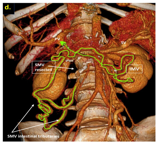 Cancers | Free Full-Text | Pancreatectomy with En Bloc Superior ...