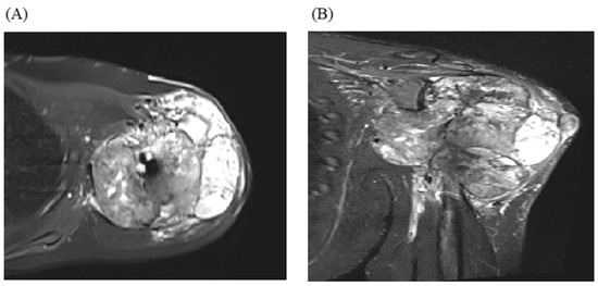 Comprehensive Insights into Chondroblastoma Metastasis: Metastatic ...