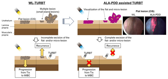 Photodynamic Diagnosis and Therapy in Non-Muscle-Invasive Bladder Cancer