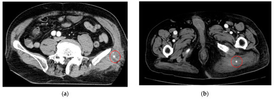 Exploring Extravasation in Cancer Patients