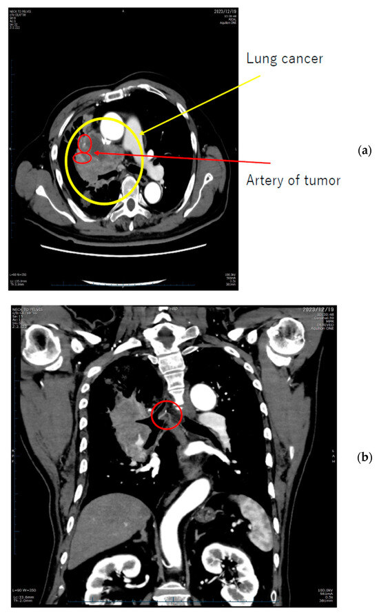 Exploring Extravasation in Cancer Patients