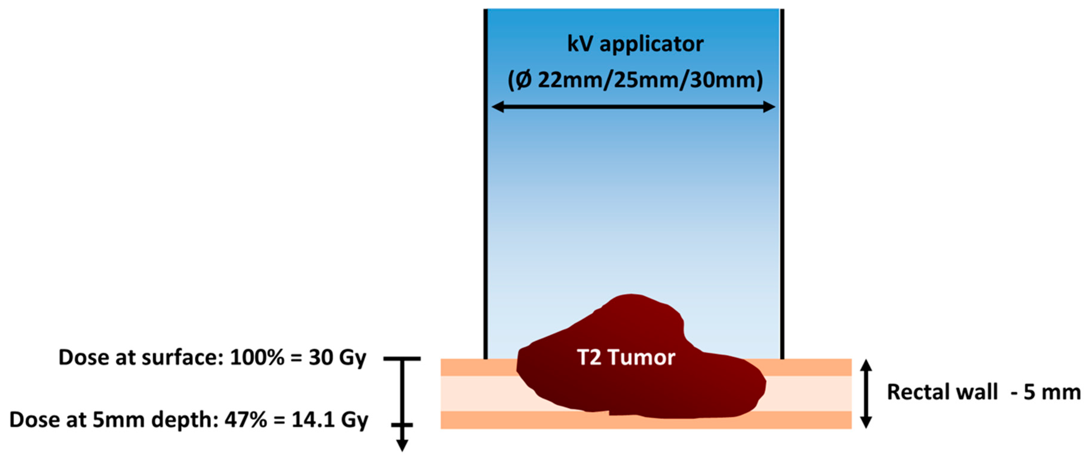 High Rates of Organ Preservation in Rectal Cancer with Papillon Contact ...