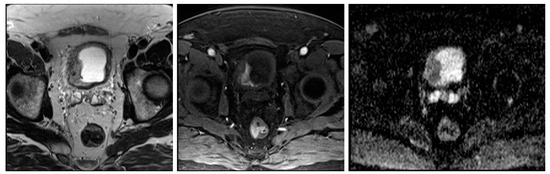 Deep Learning Algorithms for Bladder Cancer Segmentation on Multi-Parametric MRI