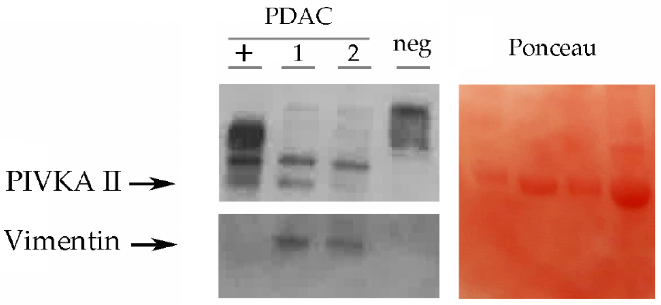 Combined PIVKA II and Vimentin-Guided EMT Tracking in Pancreatic Adenocarcinoma Combined ...