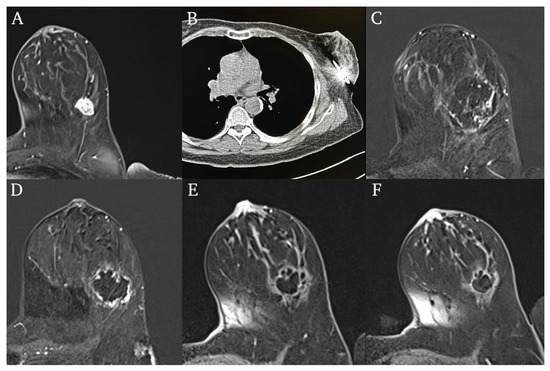 CT-Guided Percutaneous Cryoablation of Breast Cancer: A Single-Center ...