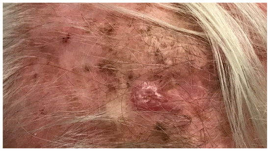 Clinical Characteristics and Special Considerations in the Management ...