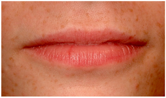 Differential Diagnosis of Pigmented Lesions in the Oral Mucosa: A ...