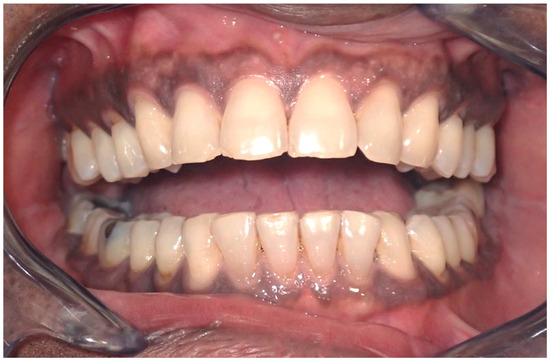 Differential Diagnosis of Pigmented Lesions in the Oral Mucosa: A ...