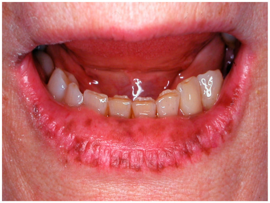 Differential Diagnosis of Pigmented Lesions in the Oral Mucosa: A ...