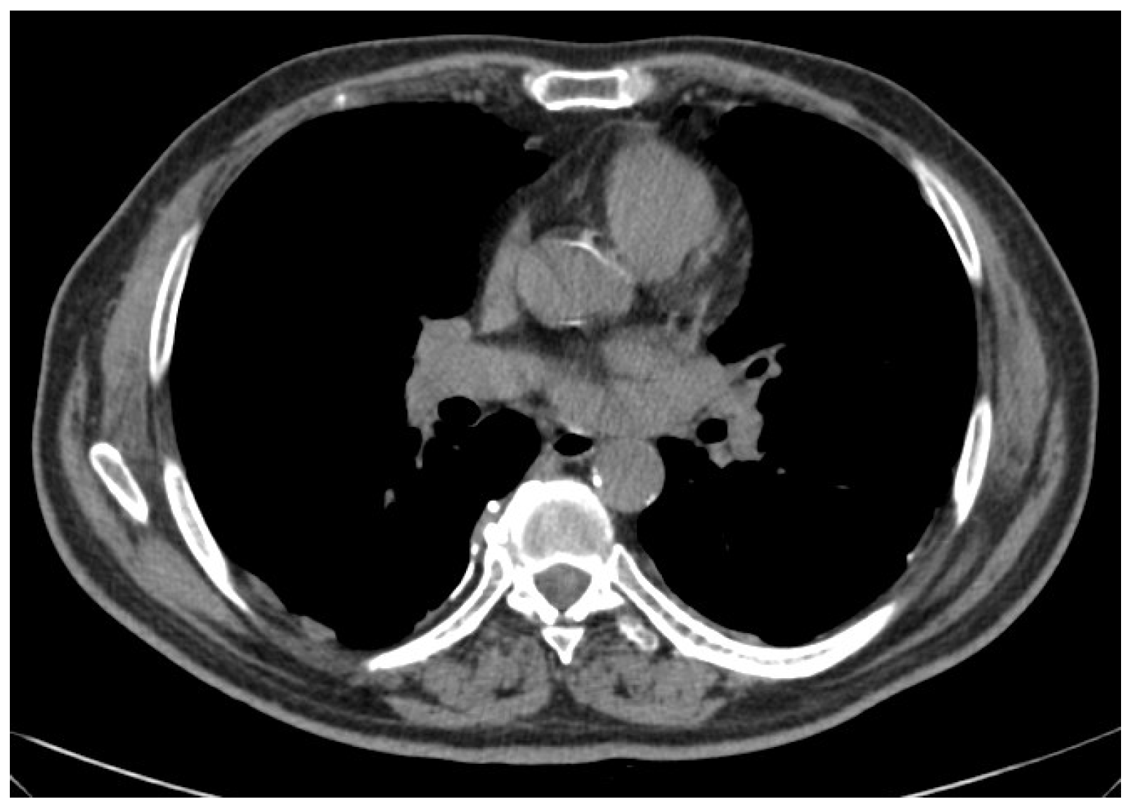 The Role of Hyperthermic Intrathoracic Chemotherapy (HITHOC) in ...