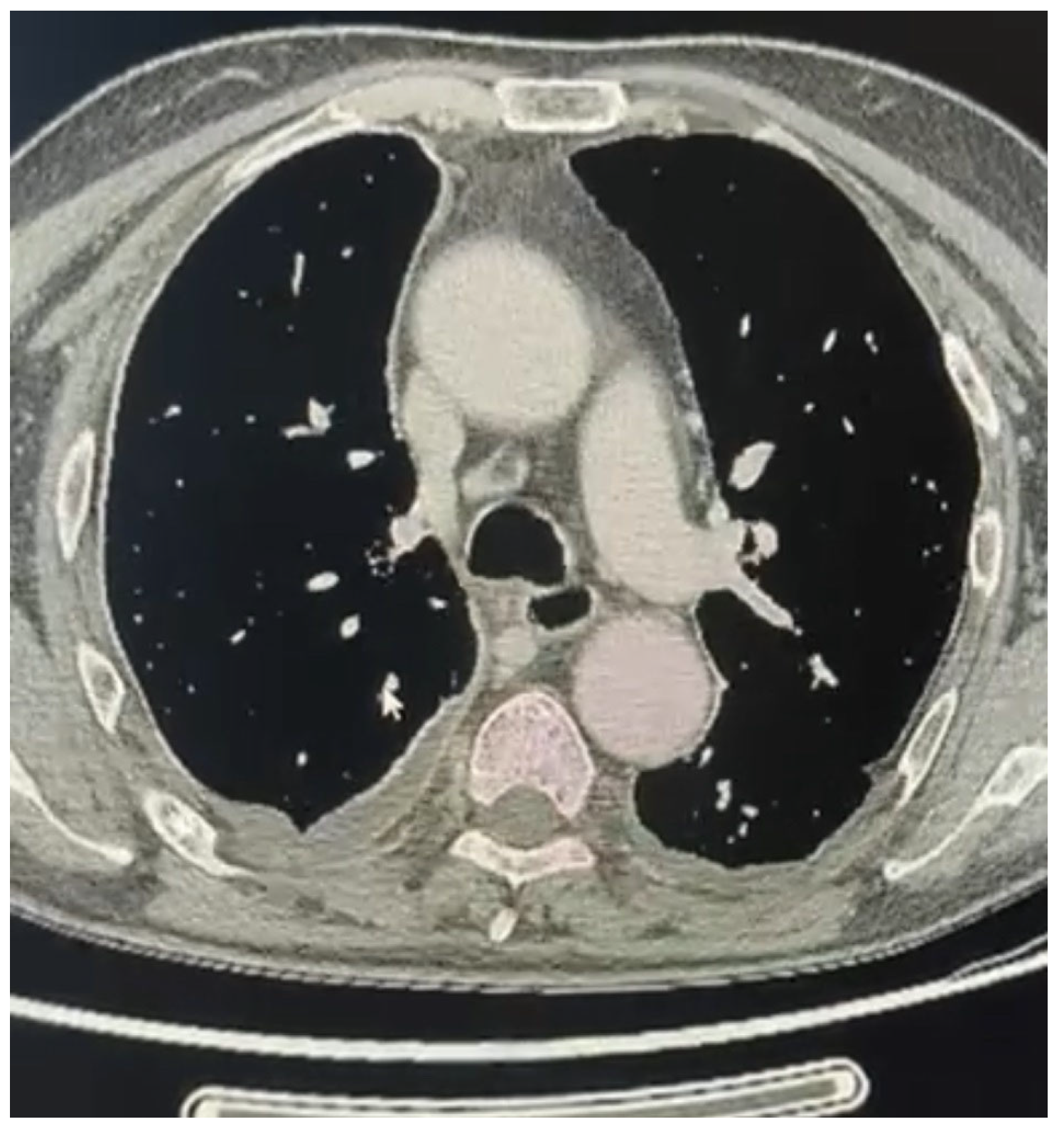 The Role of Hyperthermic Intrathoracic Chemotherapy (HITHOC) in ...