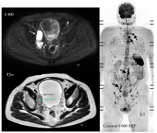 Multiparametric Whole-Body MRI: A Game Changer in Metastatic Prostate ...