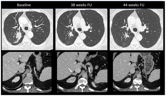 Immune-Related Adverse Events Induced by Immune Checkpoint Inhibitors ...