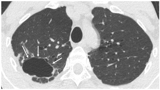 Incidental Findings in Lung Cancer Screening