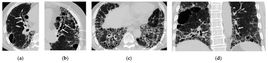 Incidental Findings in Lung Cancer Screening