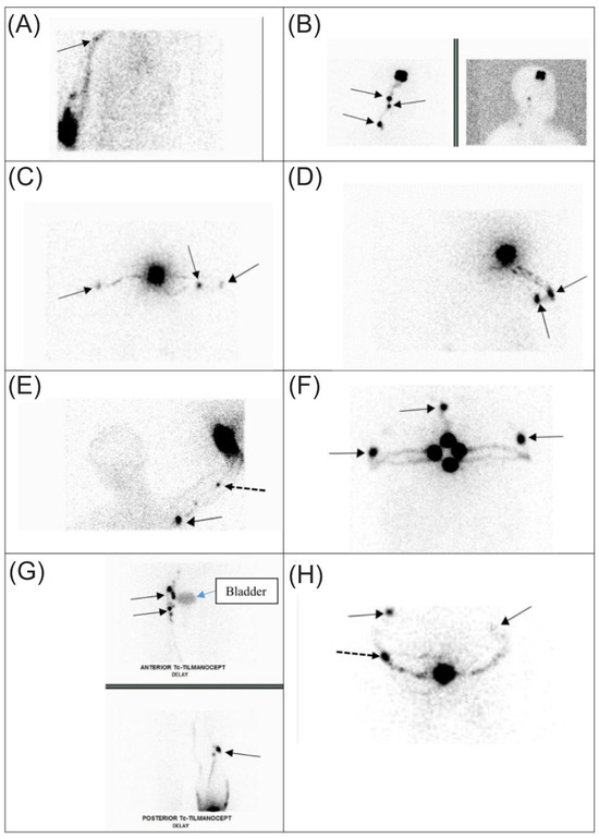 Preoperative and Intraoperative Identification of Sentinel Lymph Nodes ...