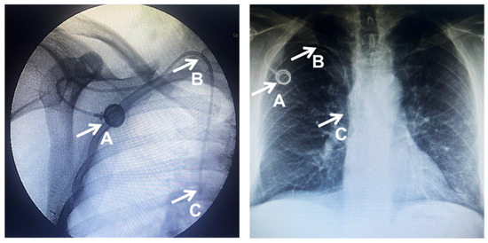 A Monocentric Analysis of Implantable Ports in Cancer Treatment: Five ...