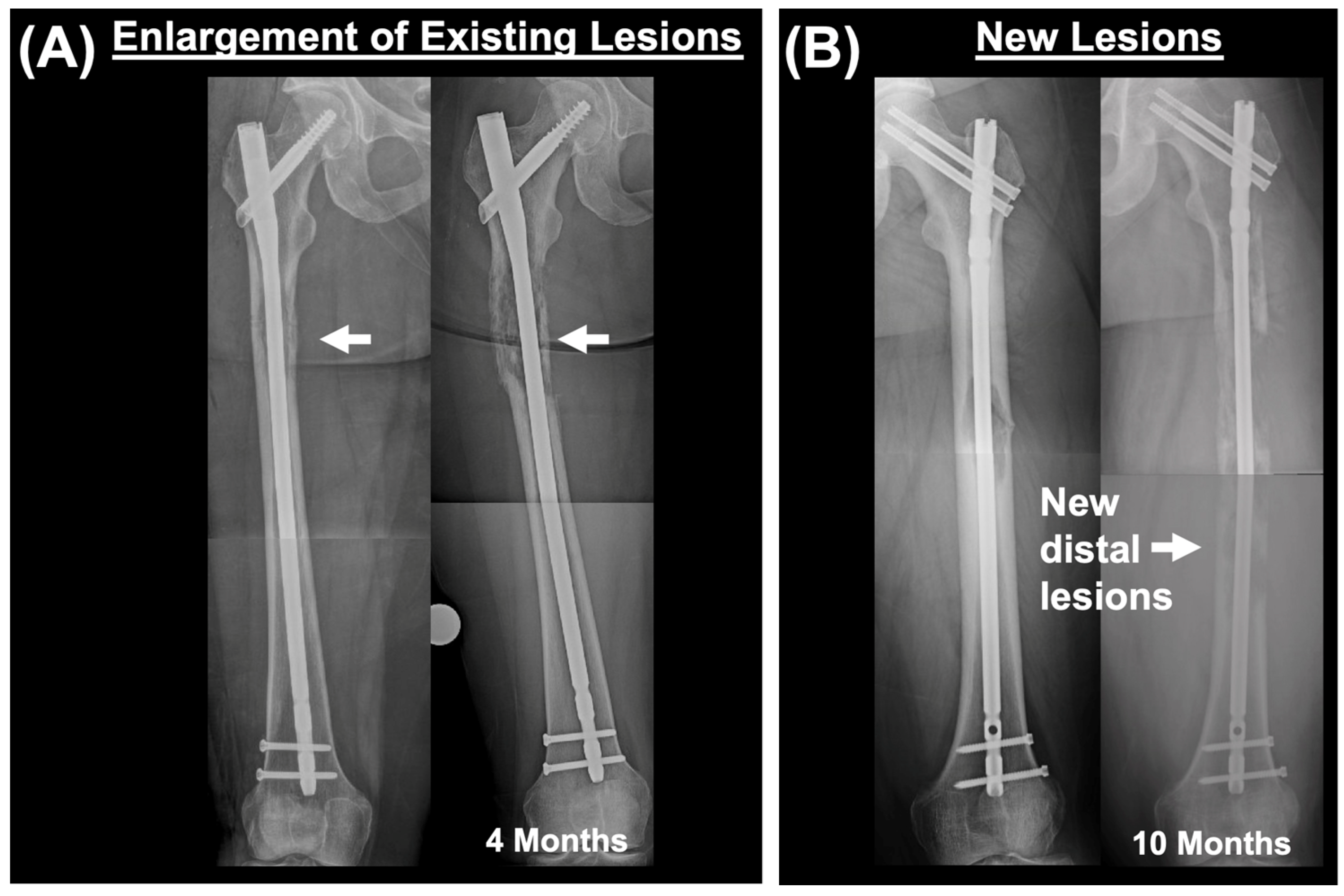 Progression of Femoral Osteolytic Metastases after Intramedullary ...