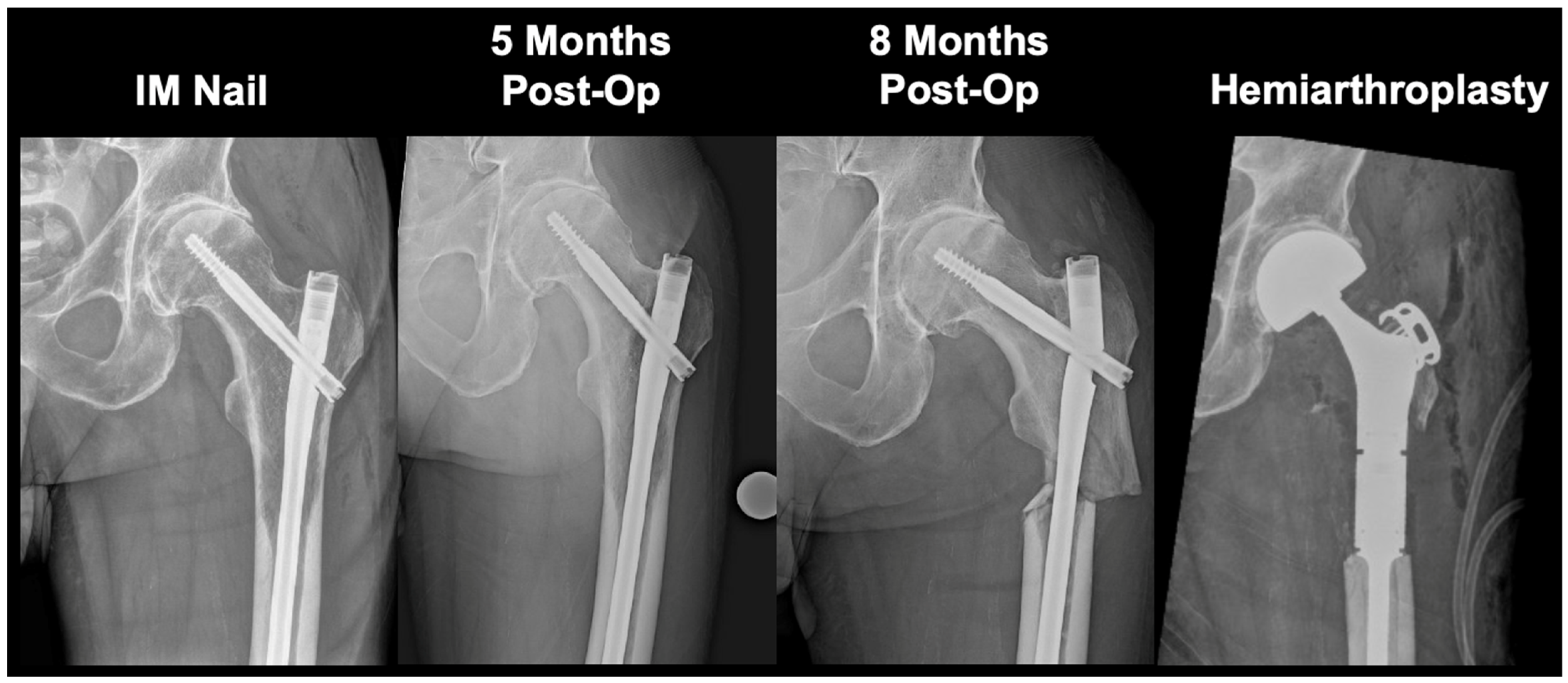 Progression of Femoral Osteolytic Metastases after Intramedullary ...