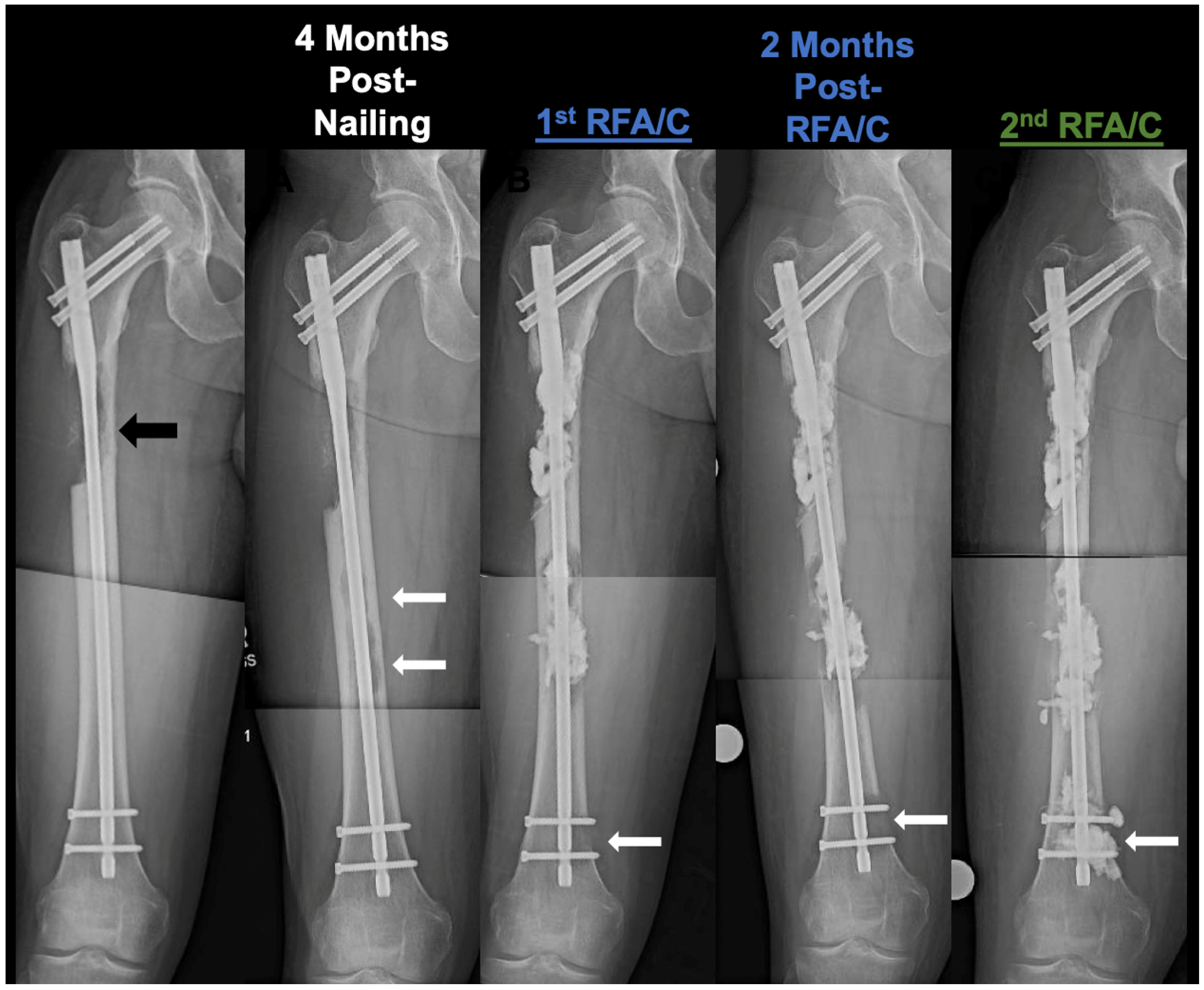 Progression of Femoral Osteolytic Metastases after Intramedullary ...