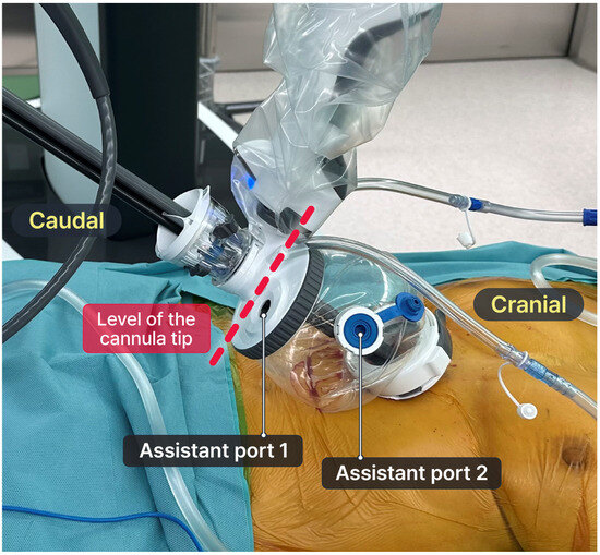 Subxiphoid Single-Port Robotic Thymectomy Using the Single-Port Robotic ...