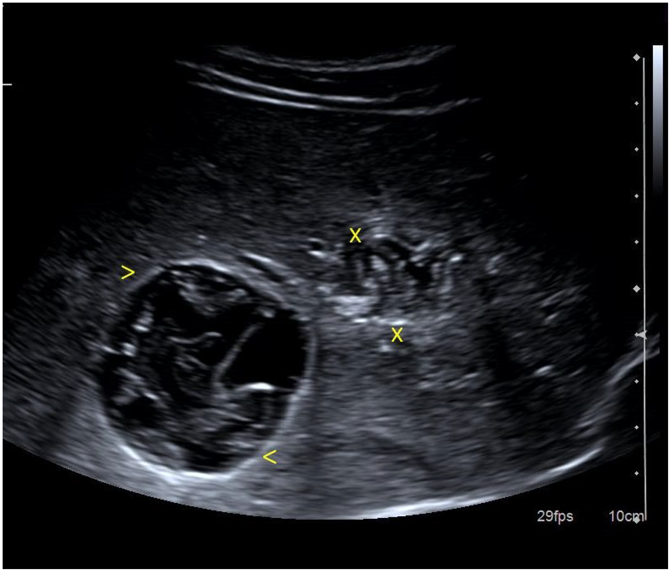 WFUMB Review Paper. Incidental Findings in Otherwise Healthy Subjects ...