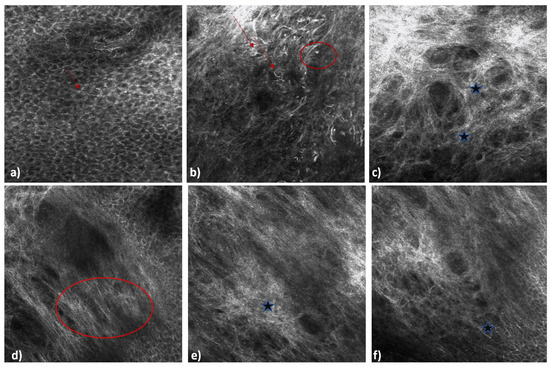 Cutaneous Squamous Cell Carcinoma: From Diagnosis to Follow-Up