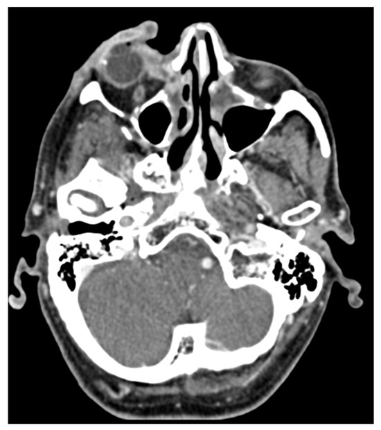 Cutaneous Squamous Cell Carcinoma: From Diagnosis to Follow-Up